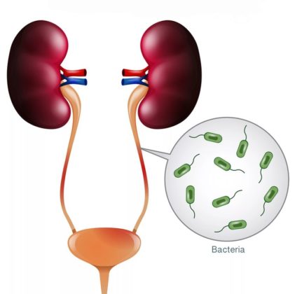 How to Diagnose and Treat a UTI - Health Life and Recipes