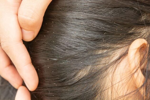 Some Lice Symptoms You Need to Be Aware Of - Health Life and Recipes